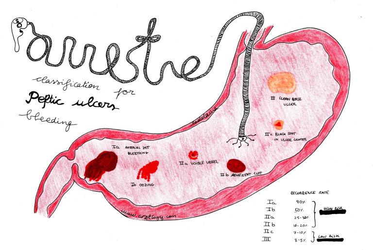 Peptic ulcer bleeding – Forrest classification – Arztlogy